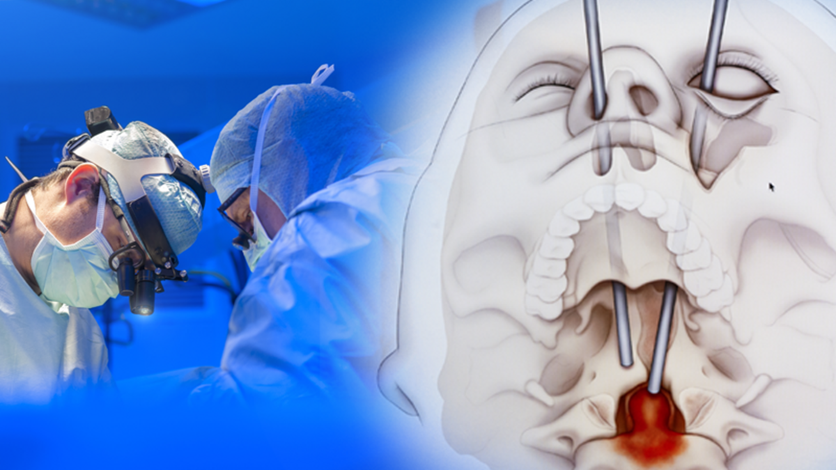 Medische primeur: chirurgen verwijderen tumor in wervelkolom van ...