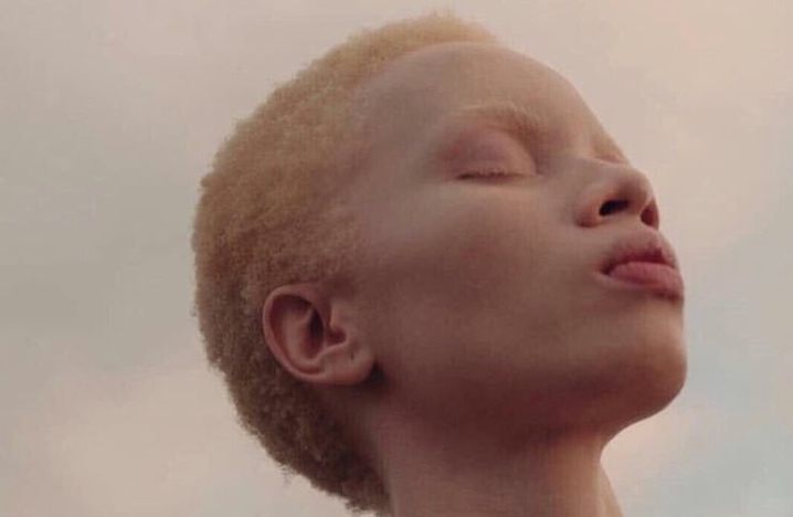 Vogue mikt op diversiteit en zet modellen met albinisme in de kijker | GVA
